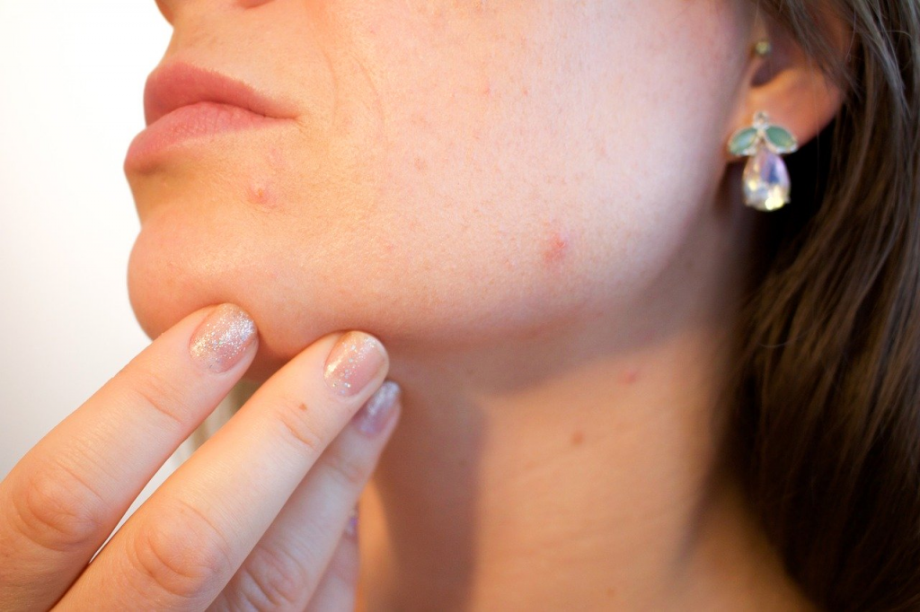 Comment cicatriser rapidement des boutons